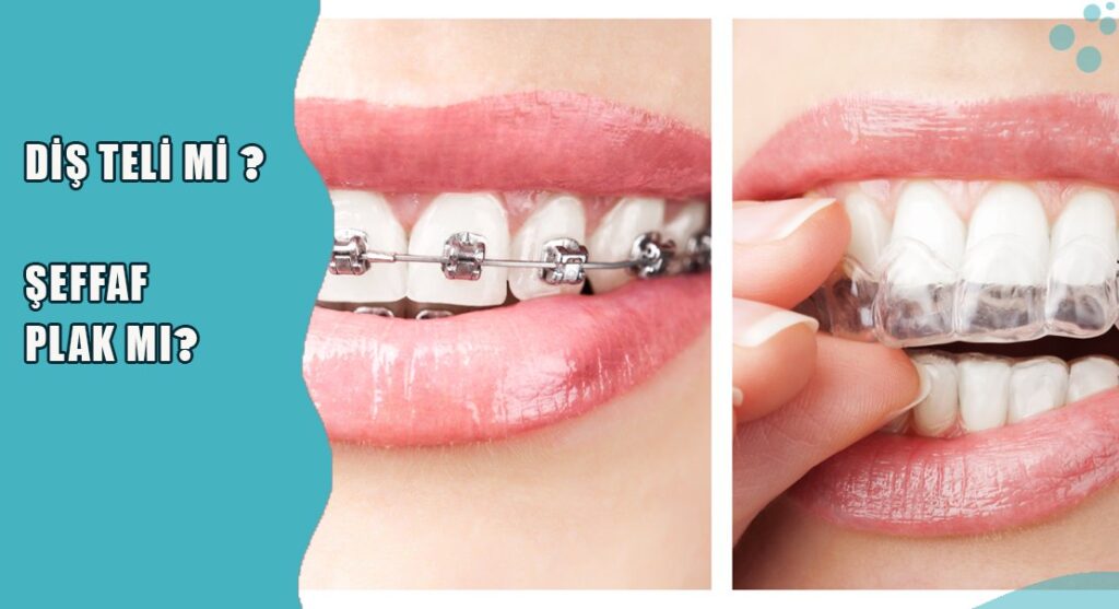 Şeffaf Plak Ne Kadar Süre Takılır? Tedavi Ne Zaman Biter?