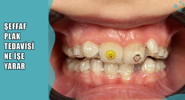 Şeffaf plak tedavisi ne işe yarar? - Dr. Dt. Özge Batmaz