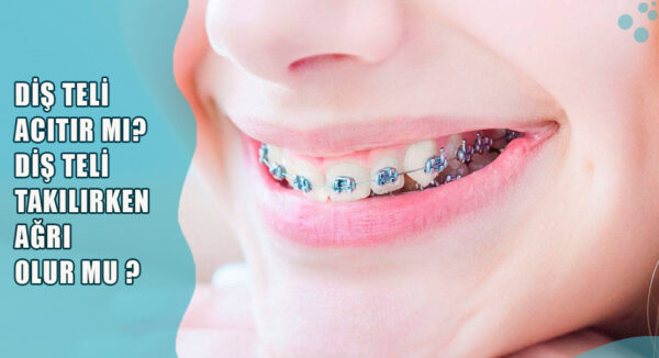 Diş Teli Acıtır Mı? Diş Teli Takılırken Ağrı Olur Mu